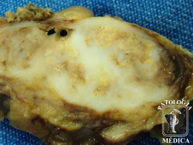 Invasive Ductal Ca Tumor Size