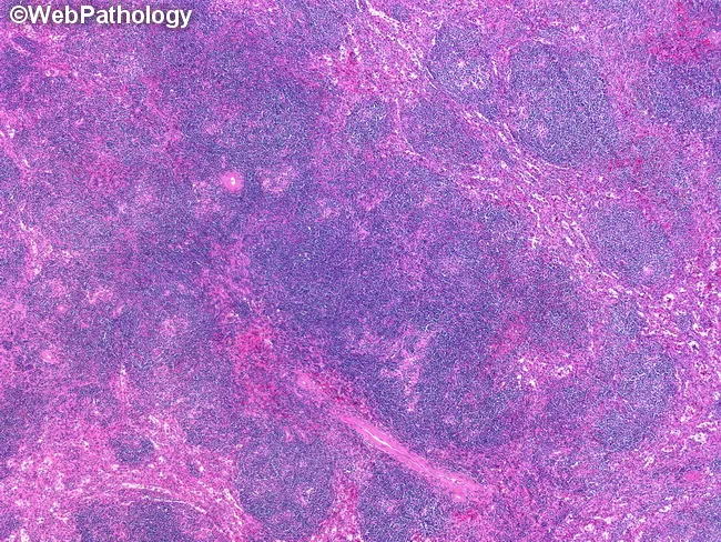 T-cell/Histiocyte-rich Large B-cell Lymphoma : Prognosis