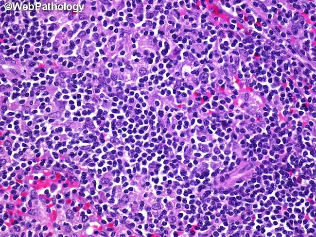 T-cell/Histiocyte-rich Large B-cell Lymphoma : Spleen