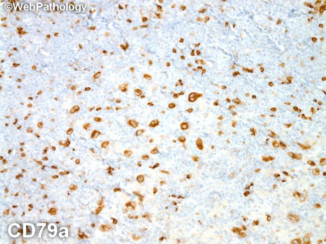 T-cell/Histiocyte-rich Large B-cell Lymphoma : CD79a