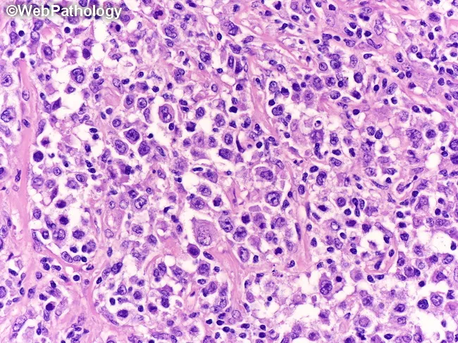 PMLBCL : Treatment & Prognosis