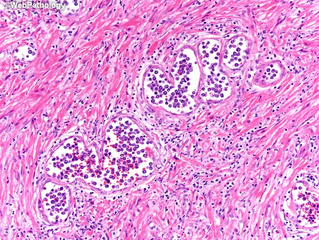 Intravascular Lymphoma : Prostate