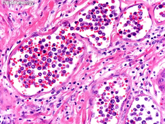 Intravascular Lymphoma : Prostate