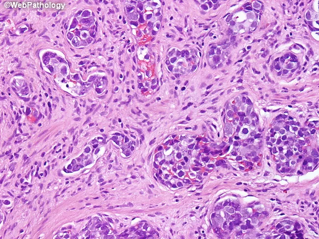 Intravascular Lymphoma : Prostate