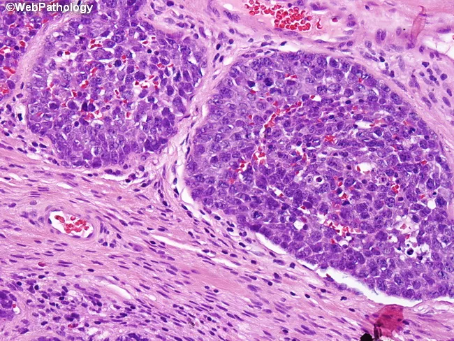 Intravascular Lymphoma : Prostate