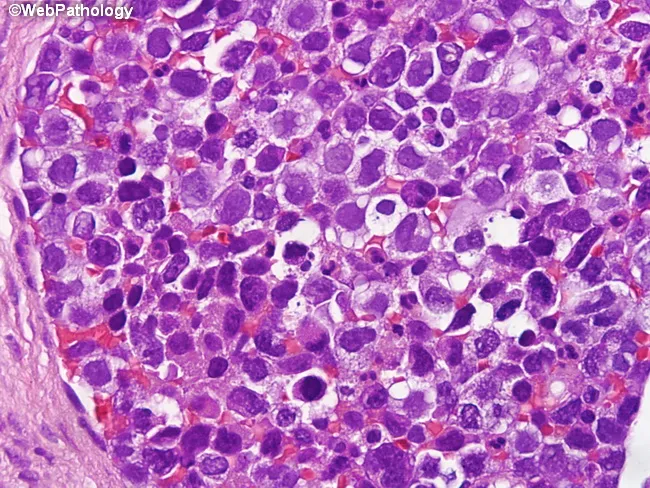 Intravascular Lymphoma : Prostate