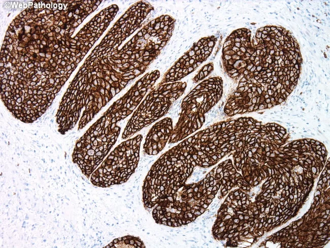 Intravascular Lymphoma : Prostate - CD20