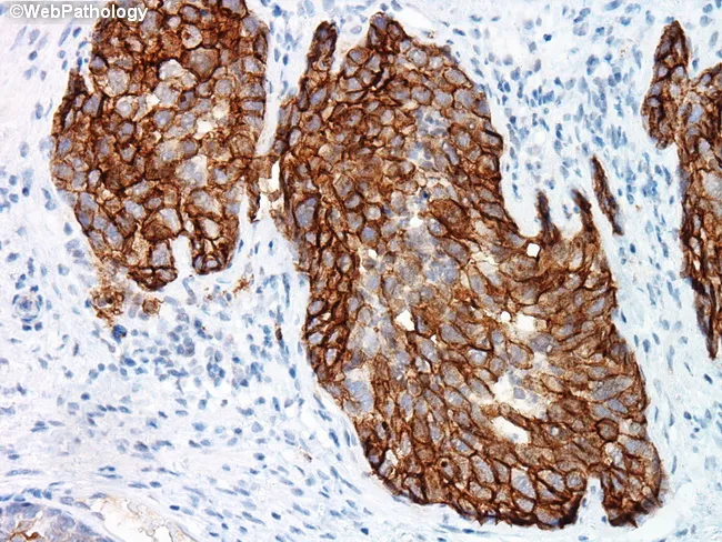 Intravascular Lymphoma : Prostate - CD30