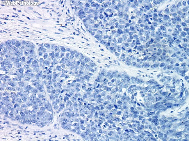 Intravascular Lymphoma : Prostate - PSA