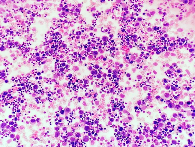 Primary Effusion Lymphoma : Clinical Features