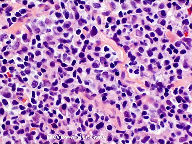 EBV+ DLBCL, NOS : Introduction
