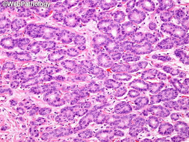 Invasive Ductal CA : Tubule Formation