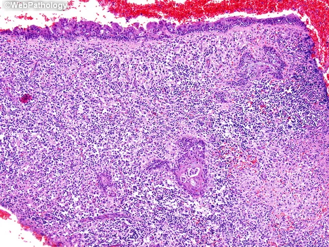 NK/T-cell Lymphoma, Nasal type