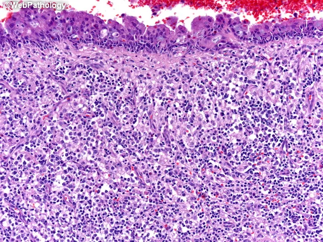 NK/T-cell Lymphoma, Nasal type