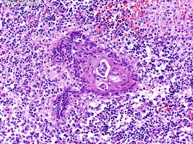 NK/T-cell Lymphoma, Nasal type