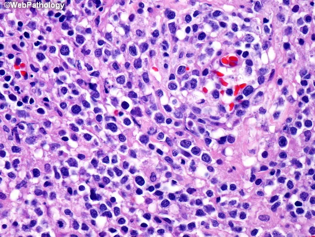 NK/T-cell Lymphoma