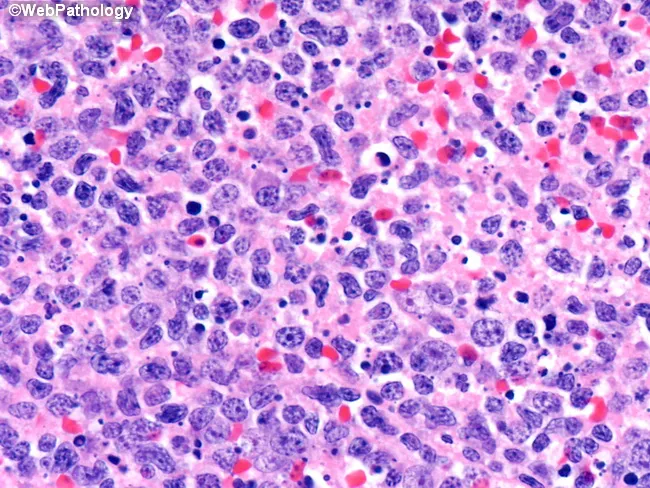 NK/T-cell Lymphoma