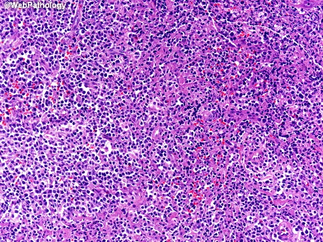 NK/T-cell Lymphoma : Differential Diagnosis
