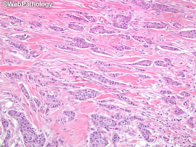 Invasive Ductal CA : Tubule Formation