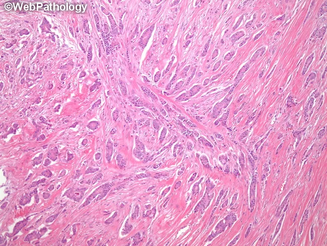 Invasive Ductal CA : Tubule Formation