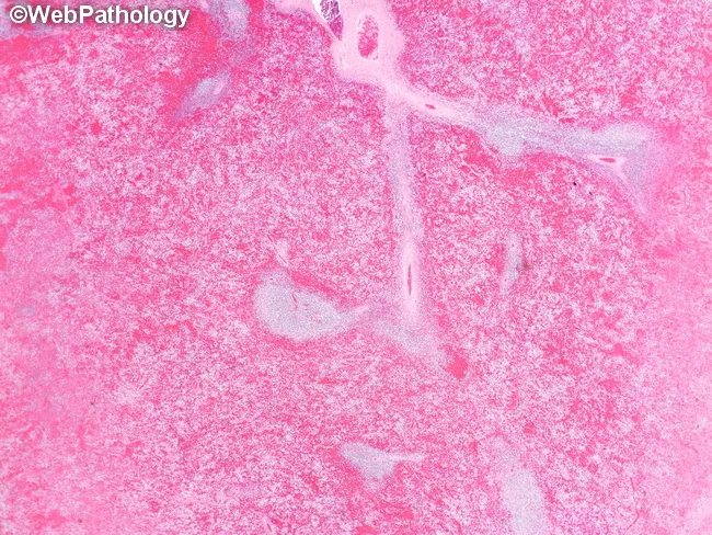 Hepatosplenic T Cell Lymphoma Introduction