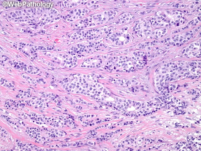 Invasive Ductal CA : Tubule Formation