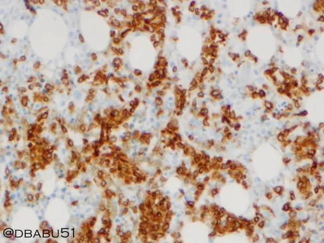 Hepatosplenic T-cell Lymphoma : CD3