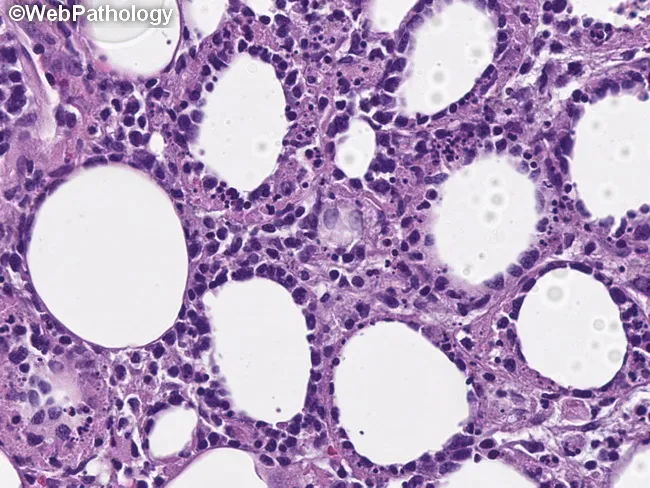 SPTCL : Prognosis & Treatment