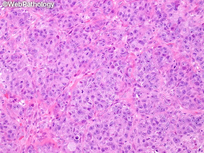 Invasive Ductal CA : Tubule Formation