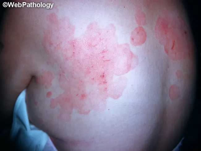 Mycosis Fungoides : Epidemiology