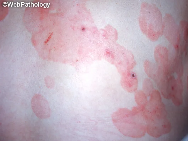 Mycosis Fungoides : Patch Stage