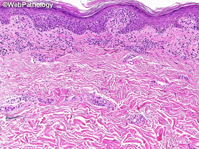 Mycosis Fungoides : Patch Stage
