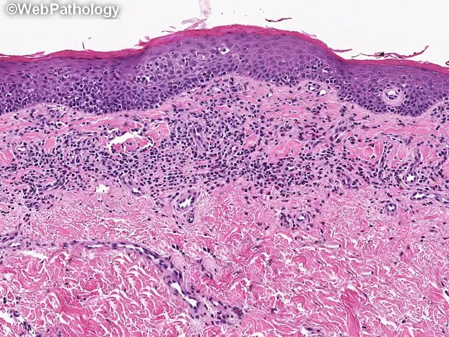 Mycosis Fungoides : Patch Stage