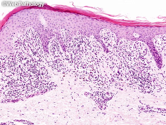 Mycosis Fungoides : Patch Stage