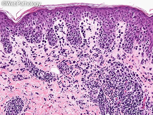 microabscess pautrier