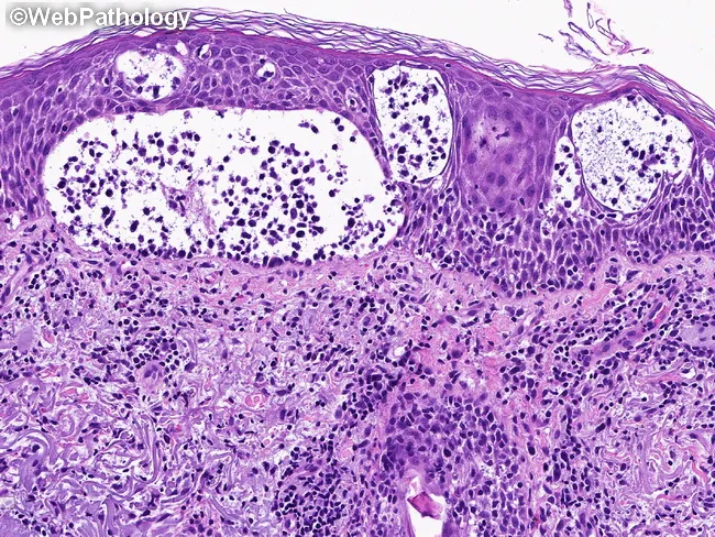 Mycosis Fungoides : Pautrier Microabscess
