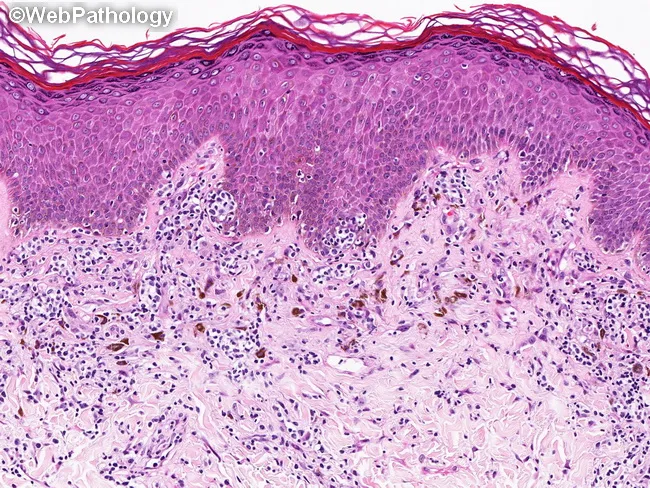 Mycosis Fungoides : Pigment Incontinence