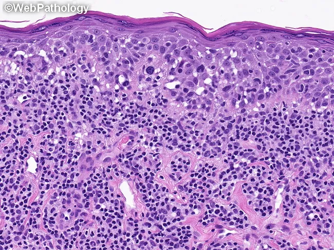 Mycosis Fungoides : Plaque Stage