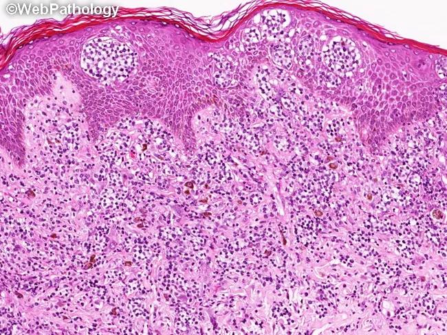 microabscess pautrier