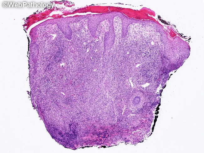 Mycosis Fungoides : Tumor Stage