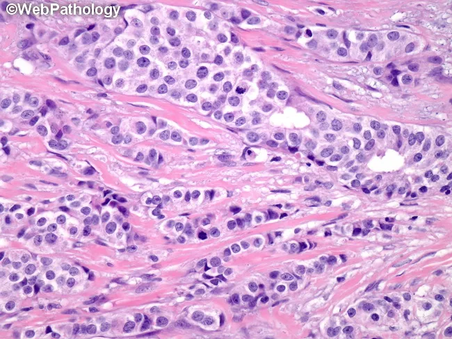 Invasive Ductal CA : Nuclear Grade