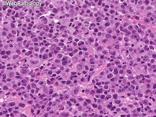 Mycosis Fungoides : Transformation