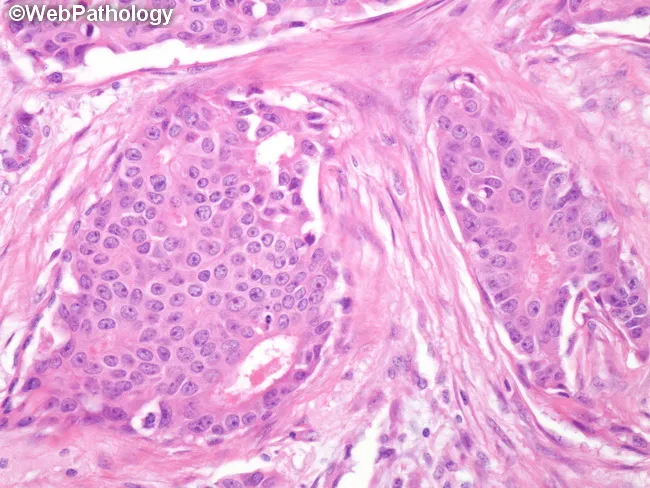 Invasive Ductal CA : Nuclear Grade