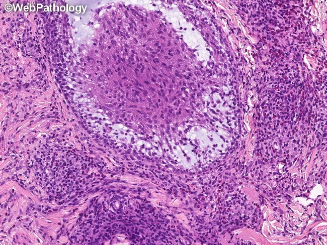 Folliculotropic Mycosis Fungoides