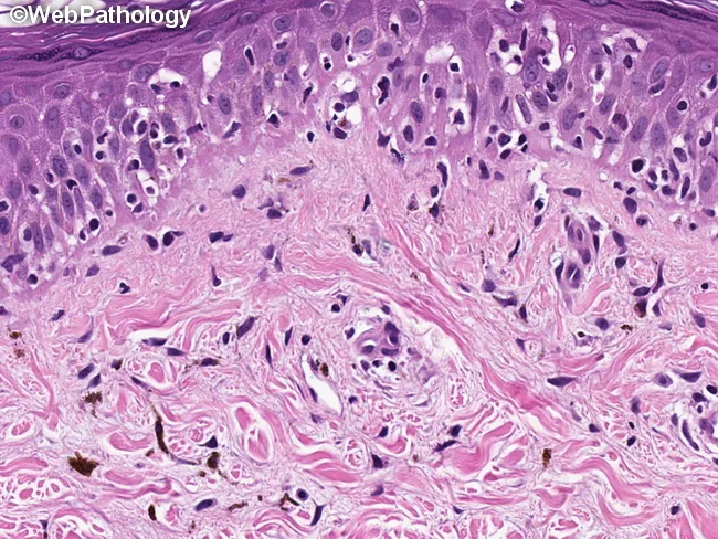 Hypopigmented Mycosis Fungoides