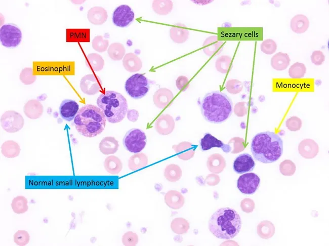 Sezary Syndrome : Diagnosis