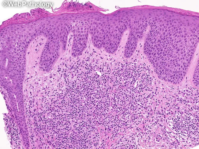 Sezary Syndrome : Microscopic Features