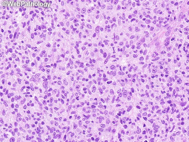 Sezary Syndrome : Microscopic Features
