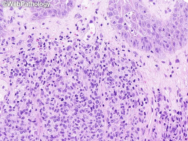Sezary Syndrome : Prognosis