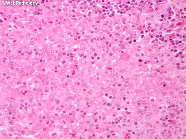 PTCL : Lymphoepithelioid Variant (Lennert's)